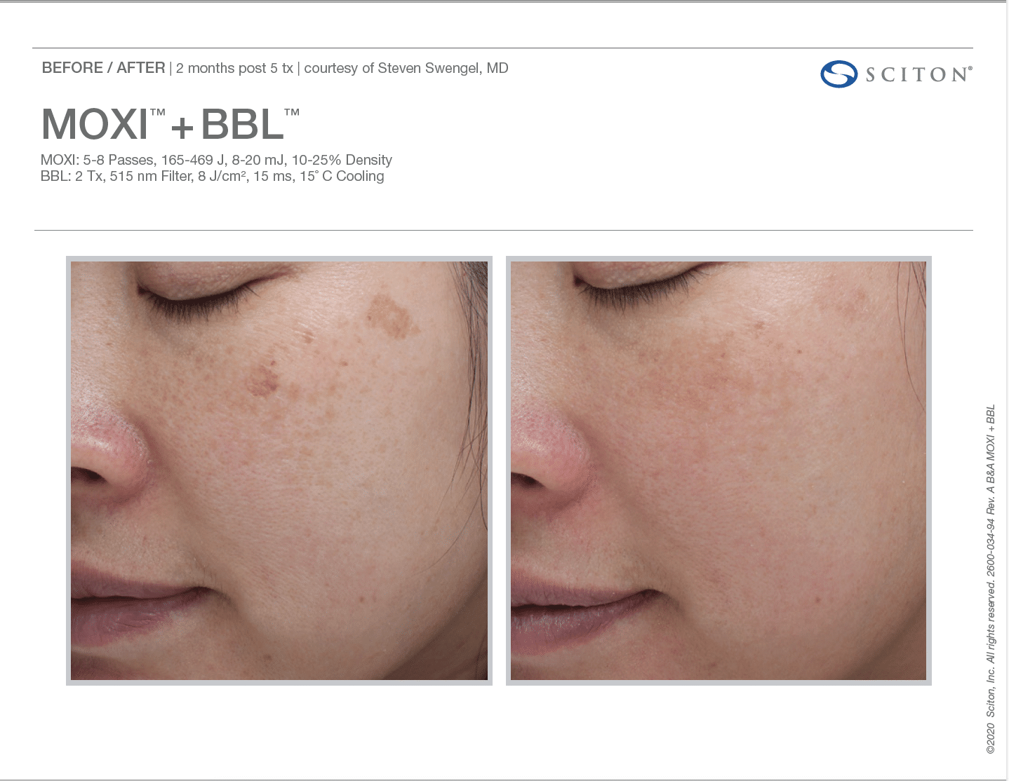 Moxi Laser In Charleston SC Charleston Medical Spa Moxi Laser In Charleston SC Charleston Medical Spa